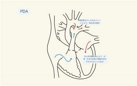 動脈管開存症の血行動態と周術期管理について シェアする挑戦者