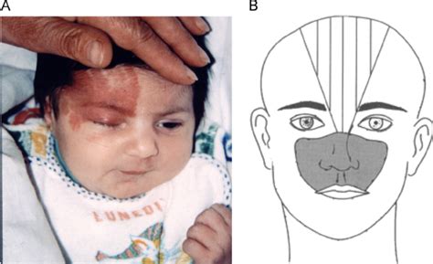 Note The Capillary Malformation Of The Nevus Fl Ammeus Type Of The