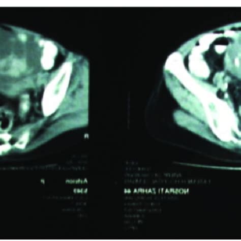 Pelvic Ct Scan Of The Patient Showing The Mass In The Pelvic Cavity