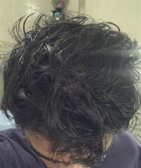 Mpb Or Diffuse Thinning Will Dermarolling 05mm With Rosemary Oil Be