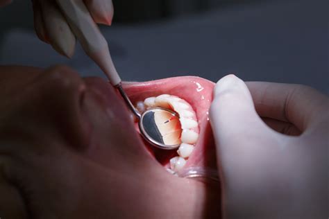 Managing Dental And Orofacial Manifestations Of Systemic Lupus