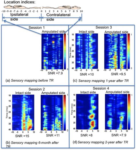 Sensory Cortical Mapping Of Different Sites Of The Upper Limb Following
