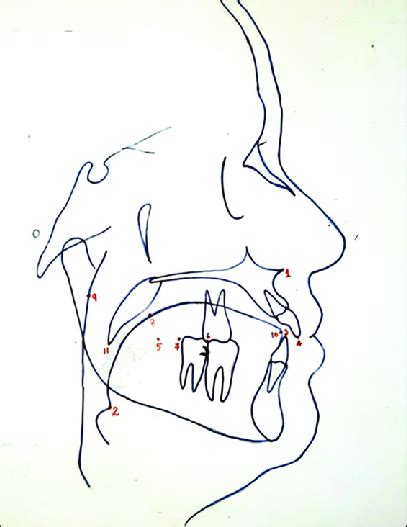 The Landmarks Marked On The Lateral Cephalogram As Described In Table 1
