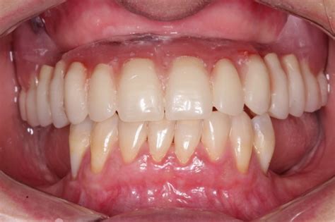 Interocclusal Space Assessment For Full Arch Implant Supported
