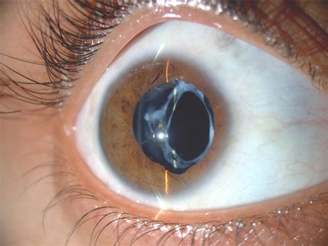 Pco Amritsar Eye Clinic