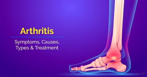 Arthritis Symptoms Causes Types And Treatment Skedoc