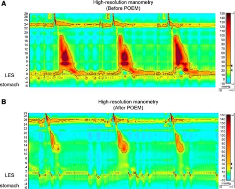 High Resolution Manometry Before And After Poem Download Scientific Diagram