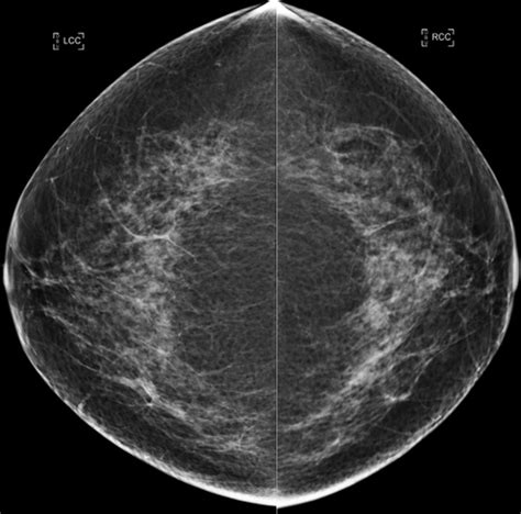 Digital Breast Tomosynthesis Lessons Learned From Early Clinical Implementation Pmc