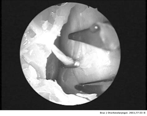 Anterior Ethmoidal Foramen