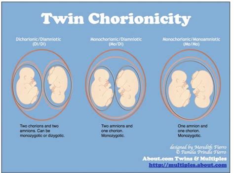 Monoamniotic Dichorionic Twins