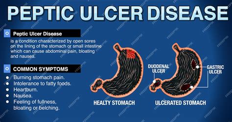 Premium Vector Peptic Ulcer Disease Explained Infographic