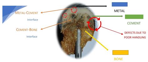 Bone Cements Used For Hip Prosthesis Fixation The Influence Of The Handling Procedures On