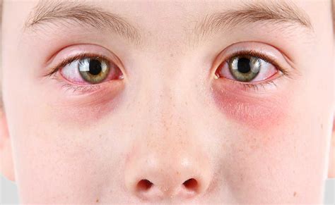 Tips Para Tratar La Conjuntivitis En Los Niños