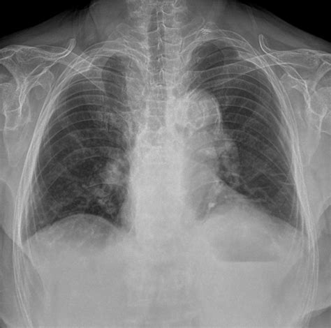 B The Admission Chest X Ray Showed Bilateral Pleural Effusions