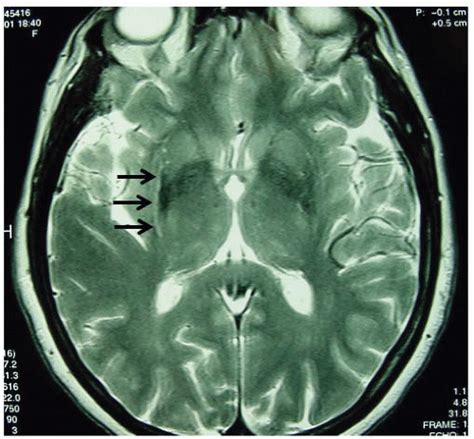 Multiple System Atrophy Parkinsonian Type Neupsy Key