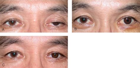 Patient 2 A Patient With Left Anophthalmic Ptosis B Elevation Of