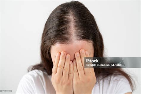 빠른 탈모로 스트레스를 받고 울고있는 여성 머리가 빠지다에 대한 스톡 사진 및 기타 이미지 머리가 빠지다 탈모 여자