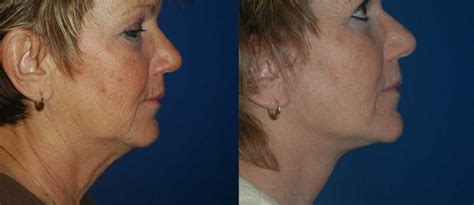 Face Gallery Chadwell Facial Plastic Surgery