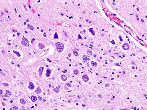 Cornu Ammonis Ca 2 3 Remaining Pyramidal Cells Show Binucleation And
