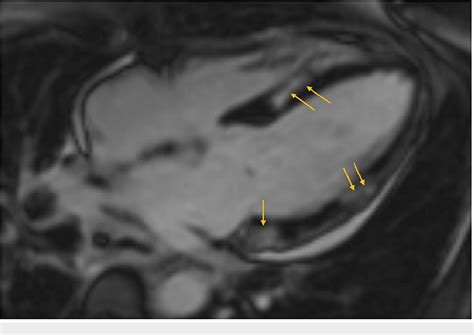 Figure 4 From Role Of 3 Tesla Magnetic Resonance Imaging In The
