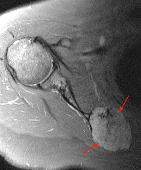 Chondroid Lesions Radsource Chondroid Lesions Radsource