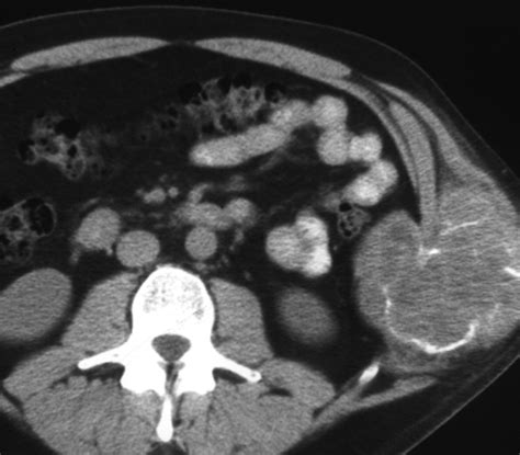 Rib Bone Lesions At Jane Shepherd Blog
