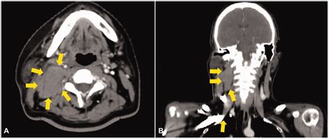 Transverse Contrast Enhanced Computed Tomography Ct Scan Image A