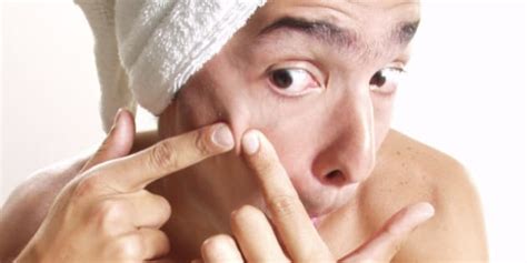 Pimple Worries Here Are Simple Ways To Pop Them Without A Scar