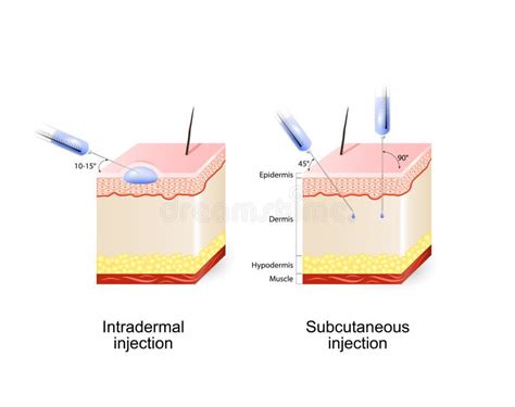 Intradermal Injection What Is A Hypodermic Needle