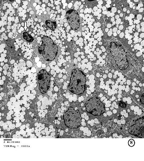 Showing Marked Accumulation Of Numerous Electron Lucent Lipid Droplets