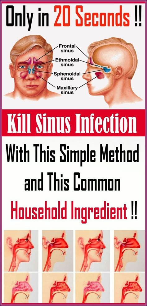 Kill Sinus Infection In 20 Seconds Artofit