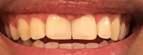 Dentist Melbourne Cbd Zen Smiles
