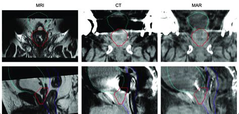 Delineation Of Target Volume And Normal Organs Magnetic Resonance