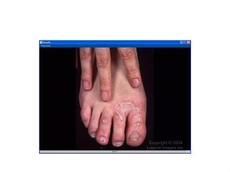 Common Fungal Infections Pptx