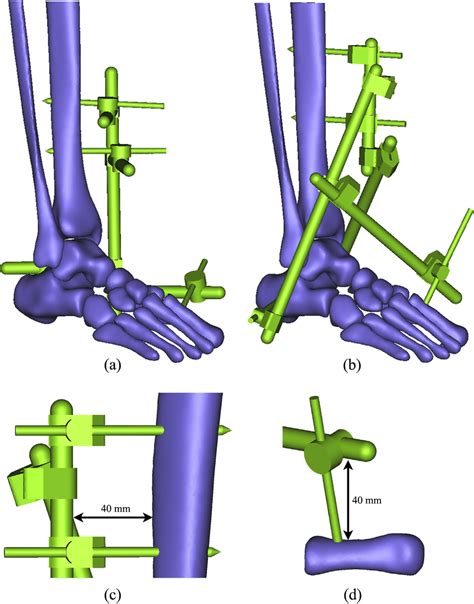 Three Dimensional Model Of Simulated Open Subtalar Dislocation A The