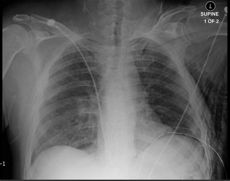 Subcutaneous Emphysema Cxr 2 Post Left Chest Tube 2 Jetem 2018 Jetem
