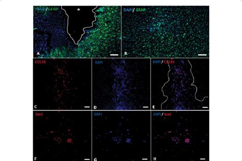 Specific Tumor Markers In Glioblastoma Sections Tumor Tissue In Panel