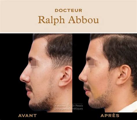 Rhinoplastie Avant Apres Paris Dr Abbou Chirurgie Esthetique