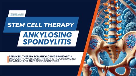 Stem Cells For Ankylosing Spondylitis A Promising Treatment Approach