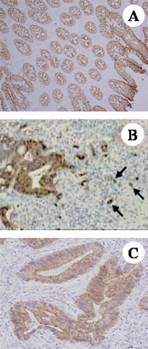 Figure 3 From Immunohistochemical Expression Of CDX2 Catenin And