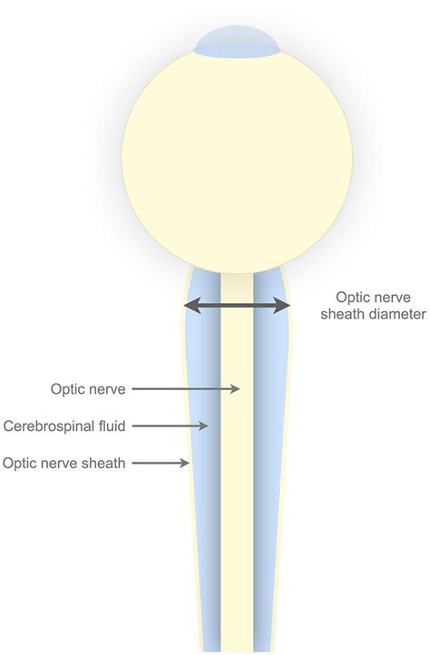Frontiers Noninvasive Intracranial Pressure Assessment By Optic Nerve