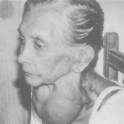 Typical Case Of Goitre In Sri Lanka Download Scientific Diagram