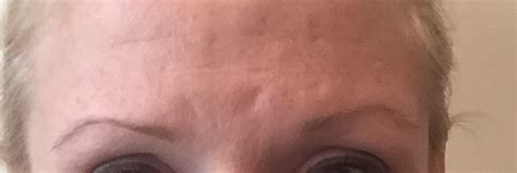 Belotero For Cortisone Dent In Middle Of Forehead Scar Treatments