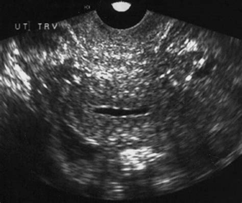 The Fluid In Uterine Cavity