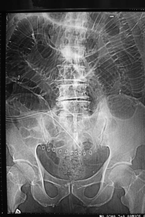 Small Bowel Obstruction Wikem