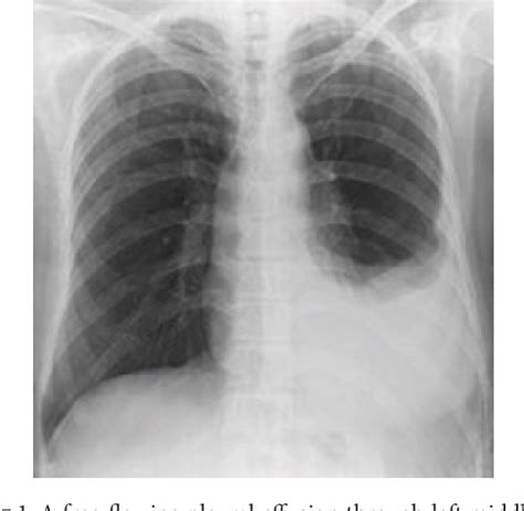 Figure 1 From Endobronchial Tuberculosis Mimicking Asthma Semantic