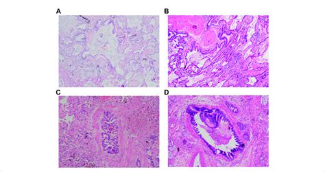 The Pathologic Image Of Sad A Airway Distortion B Airway