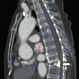 CT Demonstrates A Thoracic Vertebral Compression Fracture Arrow On Download Scientific