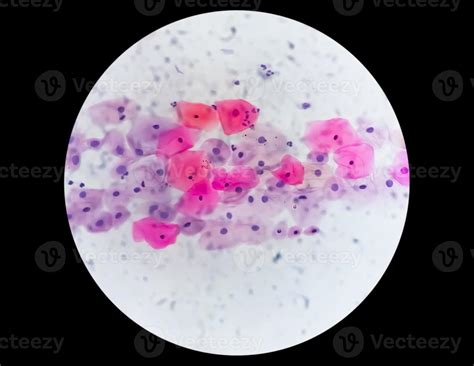 Esfregaço Papanicolau Sob Microscopia Mostrando Esfregaço Inflamatório
