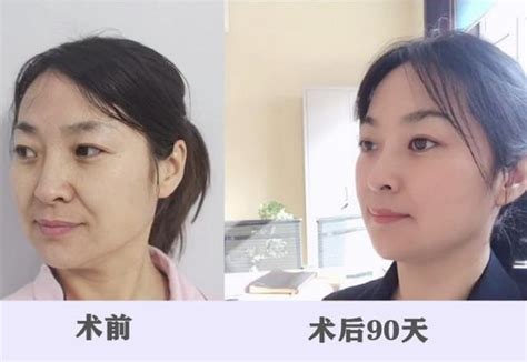 46岁到北京做面部提升，术后三个月效果分享。 知乎